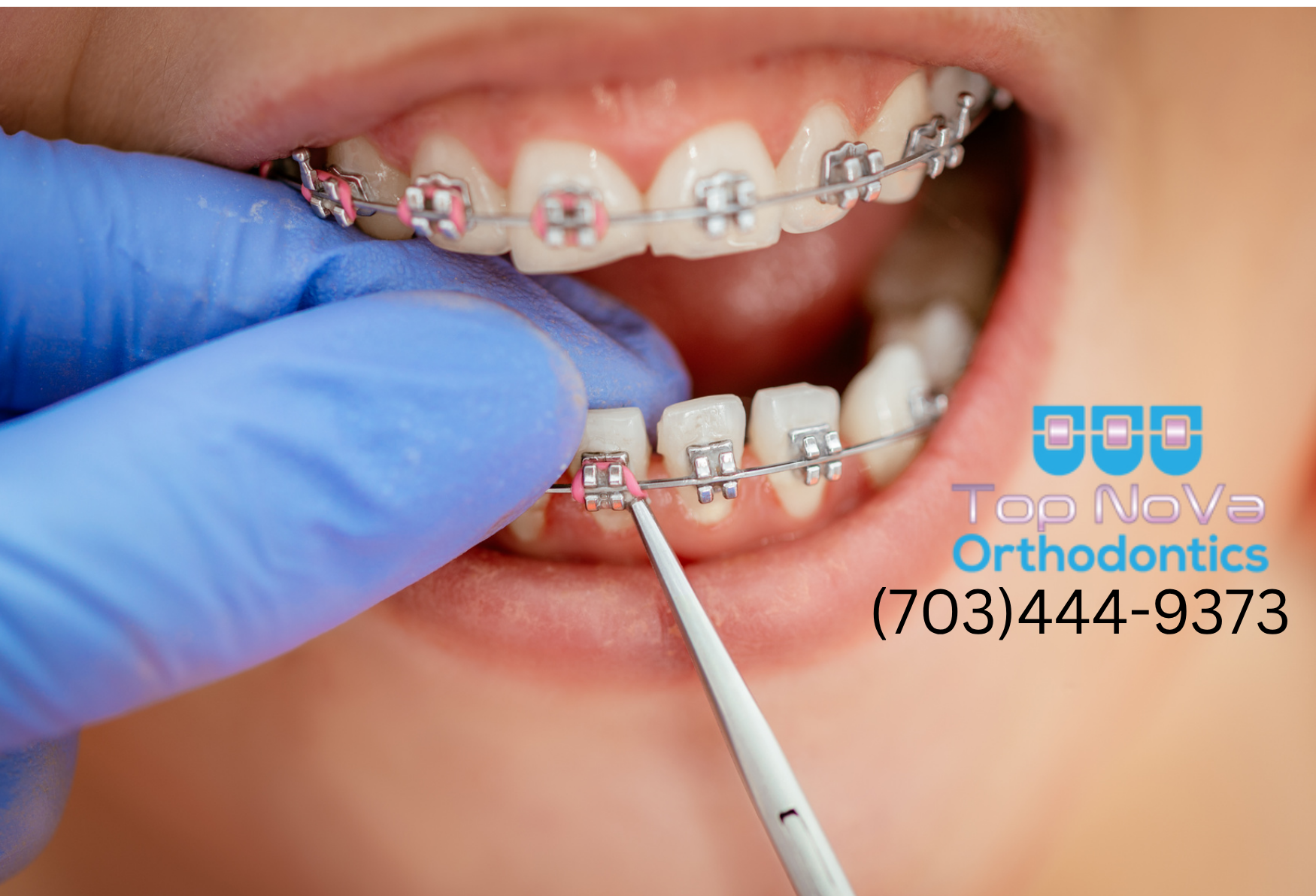 Medicaid Orthodontics Near Sterling VA- Top Nova Orthodontics