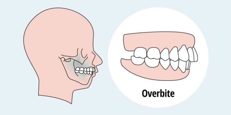 Overbite Treatment - Top Nova Orthodontics